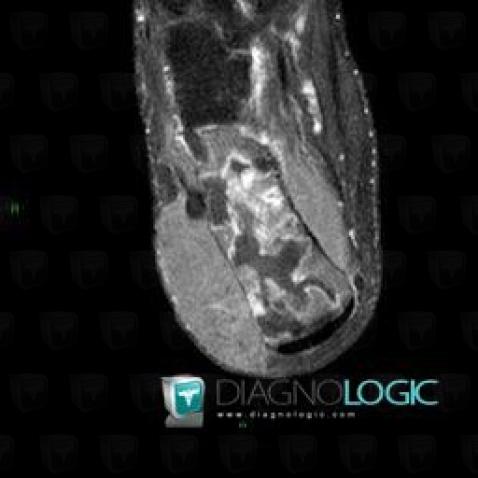 Radiology case : Lymphoma (MRI ,US) - Diagnologic