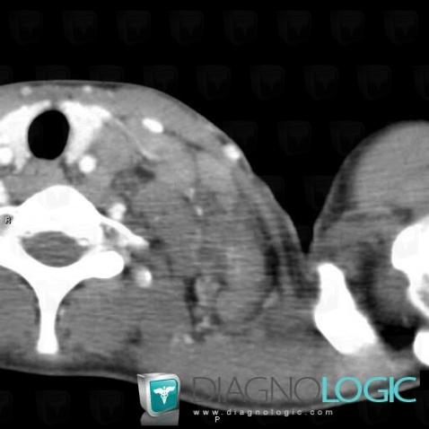 Radiology case : Lymphoma (CT) - Diagnologic