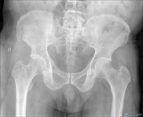 Radiology case : Lymphoma (CT ,X rays) - Diagnologic
