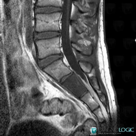 Radiology case : Lymphoma (CT ,MRI) - Diagnologic