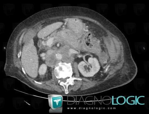 Cas radiologie : Lymphome (TDM) - Diagnologic