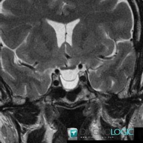 Cas radiologie : Macroadénome hypophysaire (IRM) - Diagnologic