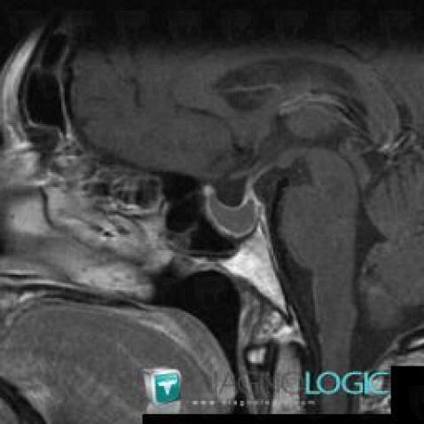 Cas radiologie : Macroadénome hypophysaire (IRM) - Diagnologic