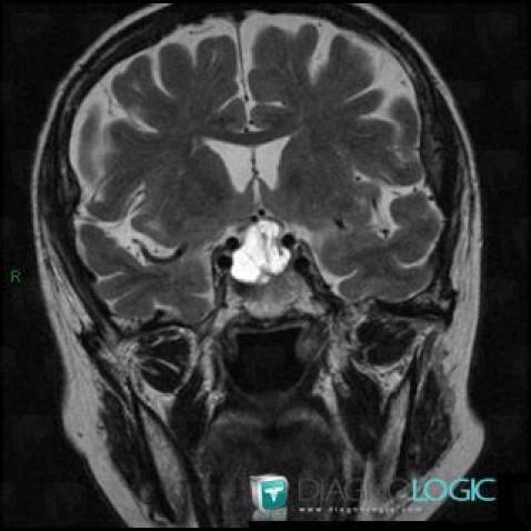 Cas radiologie : Macroadénome hypophysaire (IRM) - Diagnologic