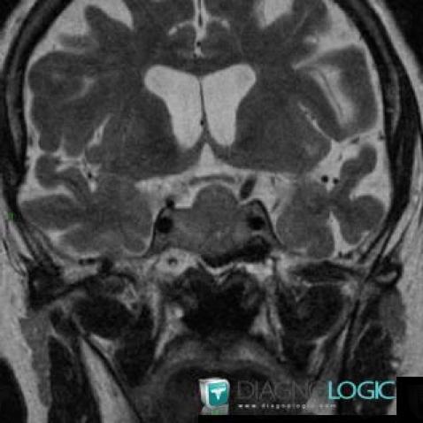 Cas radiologie : Macroadénome hypophysaire (IRM) - Diagnologic