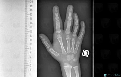 Radiology case : Macrodactyly (X rays) - Diagnologic