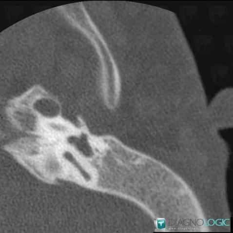 Radiology case : Major aplasia (CT) - Diagnologic