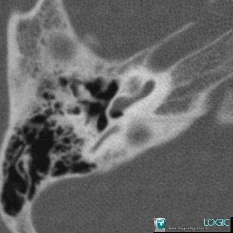 Radiology case : Major aplasia (CT) - Diagnologic
