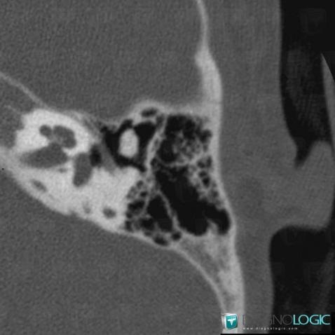 Radiology case : Major aplasia (CT) - Diagnologic