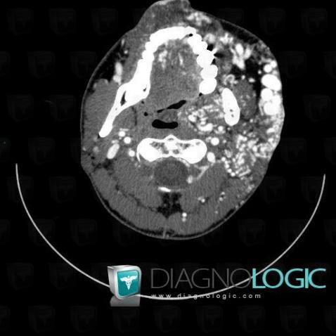 Cas radiologie : Malformation artério-veineuse (IRM ,Scanner) - Diagnologic