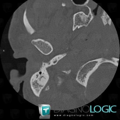 Cas radiologie : Mastoïdite (TDM) - Diagnologic