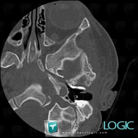 Mastoiditis Radiology Case