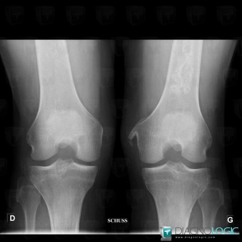 Radiology case : Bone infarct (X rays) - Diagnologic