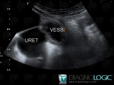 Radiology case : Hydronephrosis (US) - Diagnologic