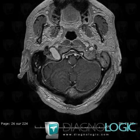 Radiology case : Meningeal fibrosis (MRI) - Diagnologic
