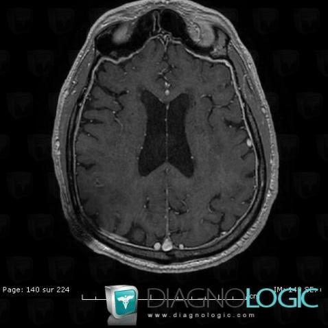 Radiology case : Meningeal fibrosis (MRI) - Diagnologic