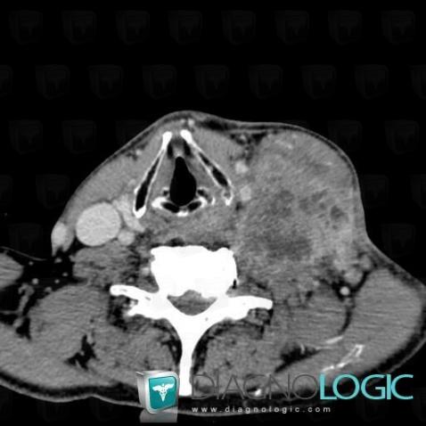 Cas radiologie : Cancer du sinus piriforme (Scanner) - Diagnologic