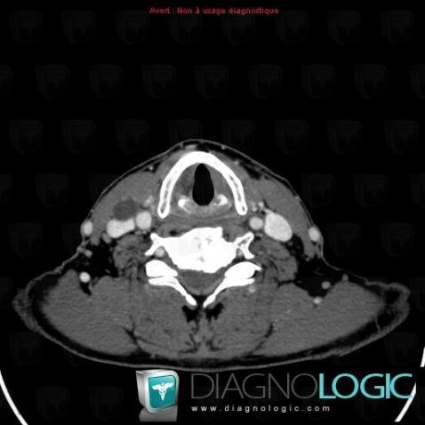 Cas radiologie : Cancer de l'amygdale (Scanner) - Diagnologic