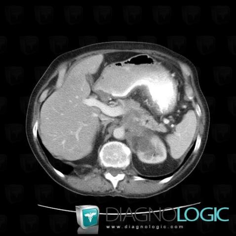 Cas radiologie : Métastase (Scanner) - Diagnologic