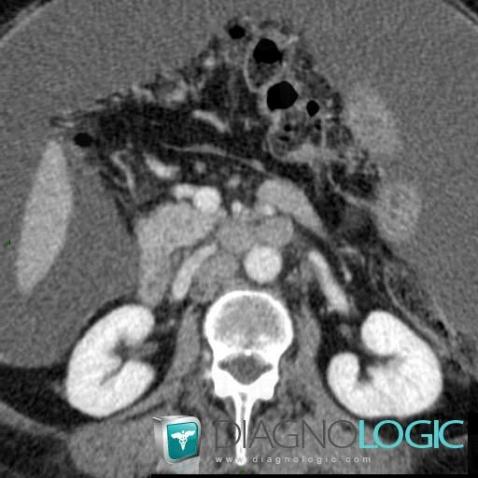 Cas radiologie : Métastase (Scanner) - Diagnologic