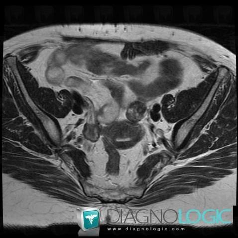 Radiology case : Metastasis (MRI) - Diagnologic