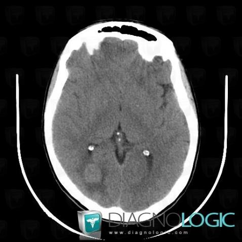 Radiology case : Metastasis (CT) - Diagnologic