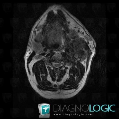 Radiology case : Tonsil cancer (CT ,MRI) - Diagnologic