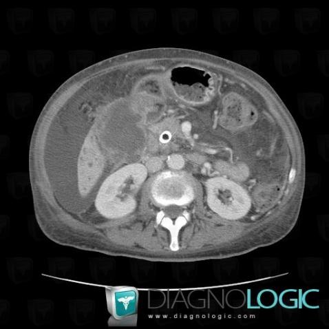 Radiology case : Metastasis (CT) - Diagnologic