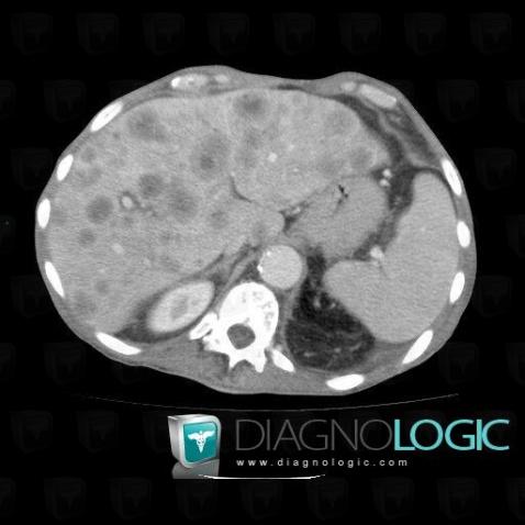 Radiology case : Metastasis (CT ,US) - Diagnologic