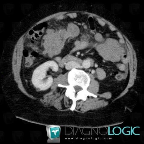 Radiology case : Metastasis (CT) - Diagnologic