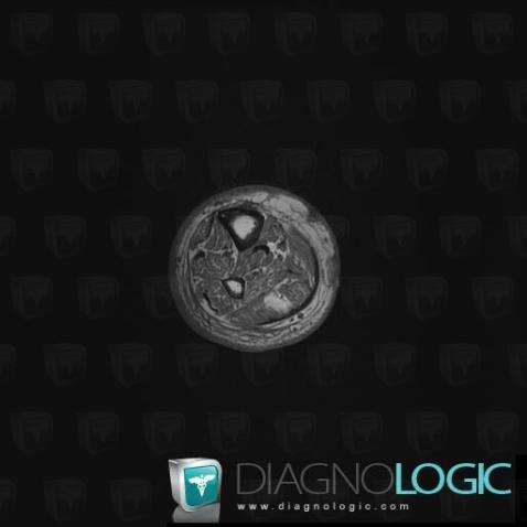 Radiology case : Metastasis (MRI) - Diagnologic