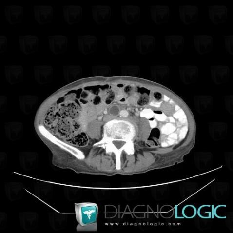 Radiology case : Metastasis (CT) - Diagnologic