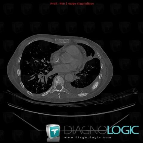 Radiology case : Metastasis (CT) - Diagnologic