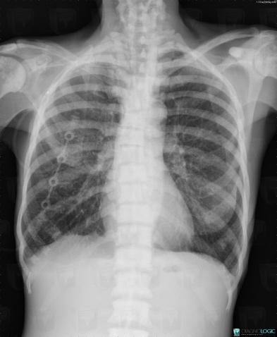 Radiology case : Metastasis (X rays) - Diagnologic