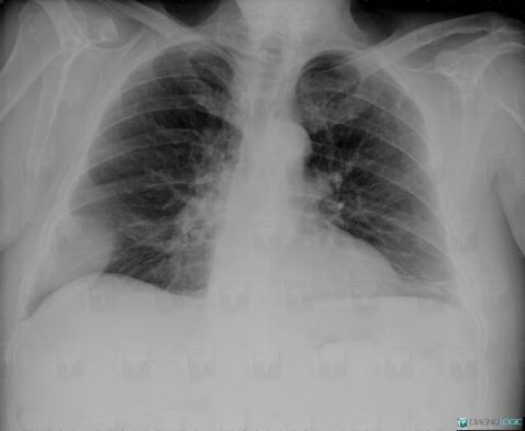 Radiology case : Metastasis (CT ,X rays) - Diagnologic