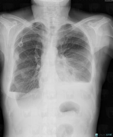 Radiology case : Metastasis (X rays) - Diagnologic