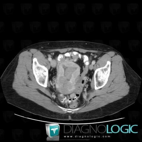 Radiology case : Metastasis (CT ,MRI) - Diagnologic