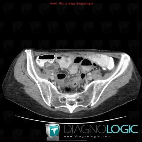 Radiology case : Mucocele (CT) - Diagnologic