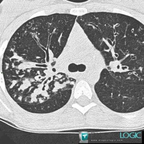 Cas radiologie : Mucoviscidose (Scanner ,Radio) - Diagnologic