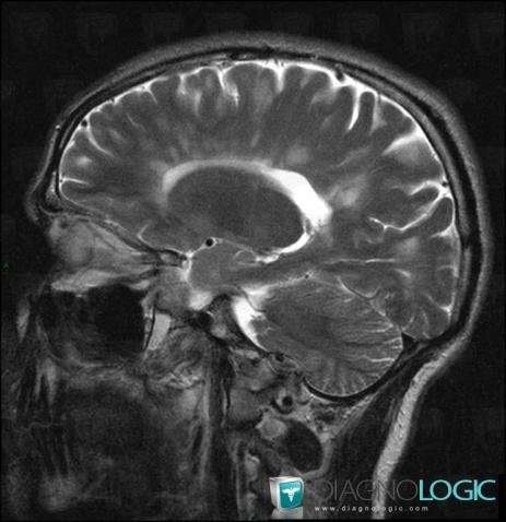 Radiology case : Multiple sclerosis (MRI) - Diagnologic