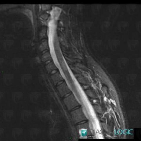 Radiology case : Multiple sclerosis (MRI) - Diagnologic