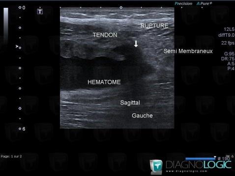 Radiology case : Muscle rupture / Thigh (US) - Diagnologic