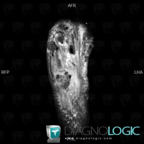 Cas radiologie : Mycetome (IRM) - Diagnologic