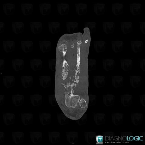Cas radiologie : Mycetome (Scanner ,Radio ,IRM) - Diagnologic