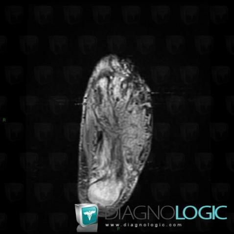 Cas radiologie : Mycetome (Scanner ,Radio ,IRM) - Diagnologic