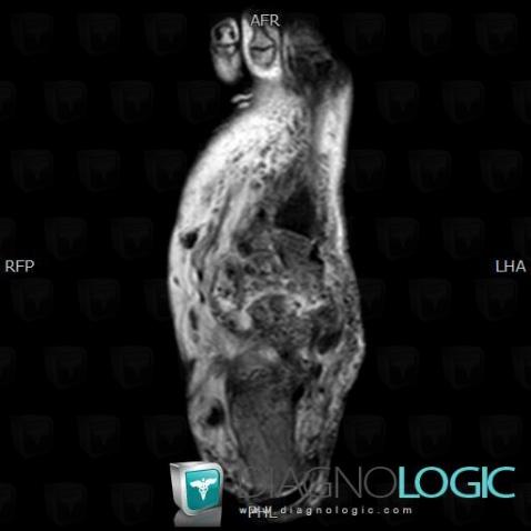 Cas radiologie : Mycetome (IRM) - Diagnologic