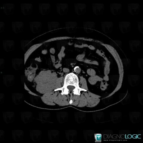 Cas radiologie : Myélome multiple (Scanner ,IRM) - Diagnologic