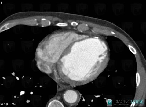 Radiology case : Myocardial infarction (CT) - Diagnologic