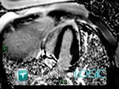 Radiology case : Myocarditis (MRI) - Diagnologic