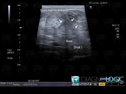 Radiology case : Myo aponeurotic lesion (US) - Diagnologic